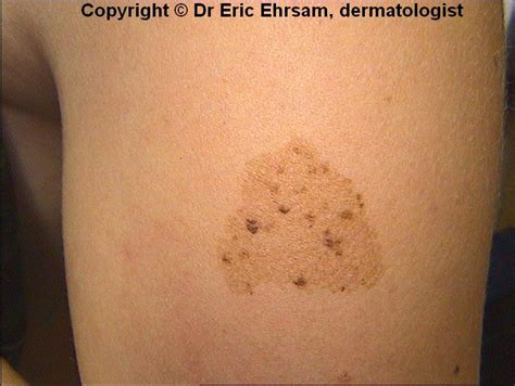Dermoscopy Nevus Spilus