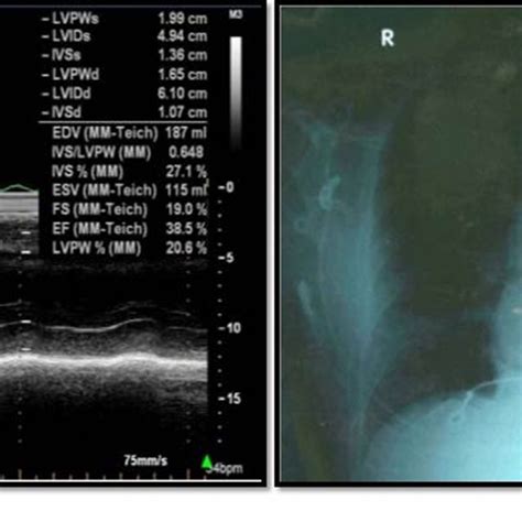 A −m Mode Of Lv Showing Moderate Lv Systolic Dysfunction Ef 40 B − Download Scientific
