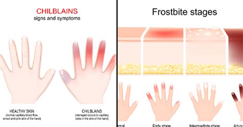 Knowing The Differences Between Chilblains And Frostbite Could Save Your Fingers Twistedsifter