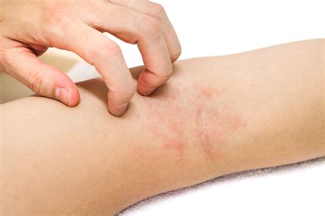 Dermatitis Numularis Adalah Tanda Penyebab Gejala Cara Mengobati