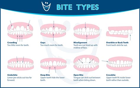 Understanding The Different Types Of Bites Tandheelkunde