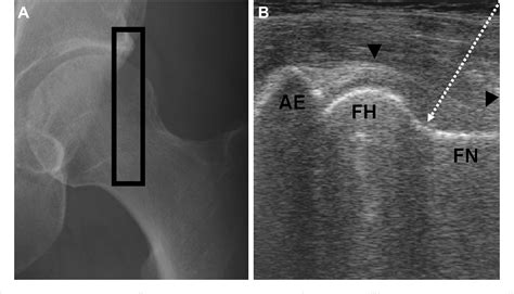 Figure 1 From Factors Influencing Discomfort During Anterior Ultrasound‐guided Injection For Hip