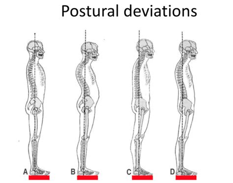 Postural Deviations Quiz