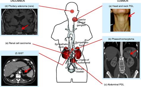 Paraganglioma Head