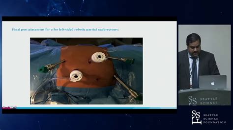 02 Transperitoneal Partial Nephrectomy Positioning Port Placement Docking Ketan Badani Md