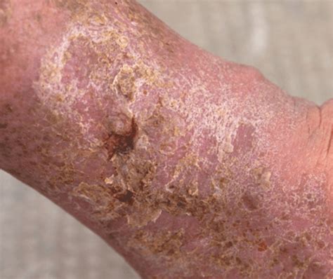 Wound Care And Lymphedema The Transformative Power Of Compression