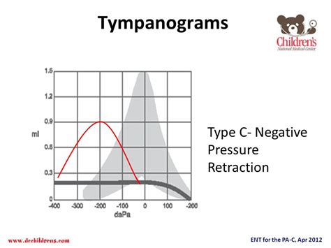 Sensorineural Hearing Loss Tympanogram Sensorineural Hearing Loss Tympanogram
