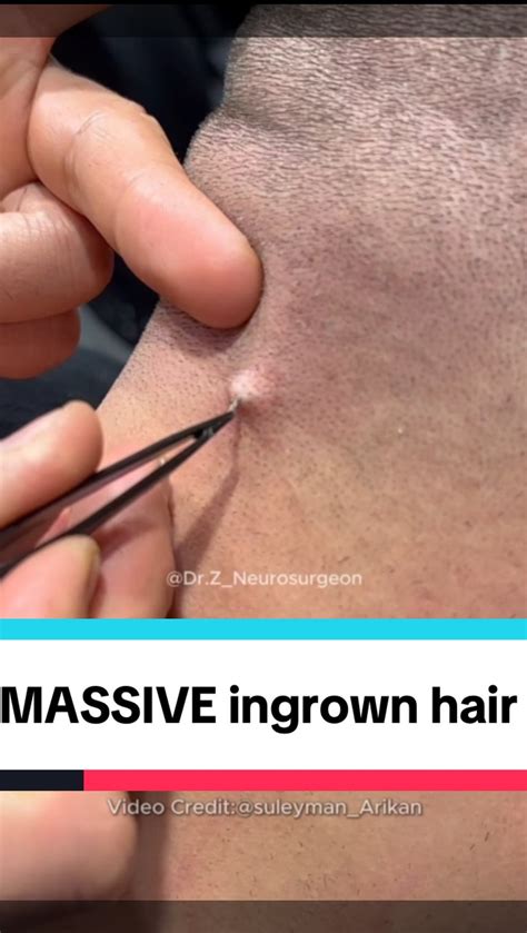 Ingrown Pubic Hair Hard Lump Under Skin