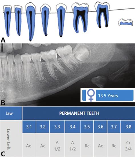 Illustration Of The Radiographic Analysis Performed For Dental Age