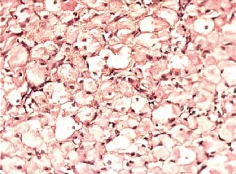 Granular Cell Tumor Hande X400 Download Scientific Diagram