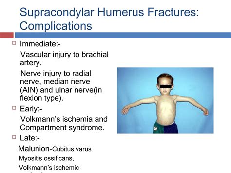 Fracture Of Distal End Humerus Ppt