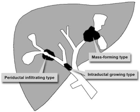Imaging Of Cholangiocarcinoma Visceral Medicine Karger Publishers