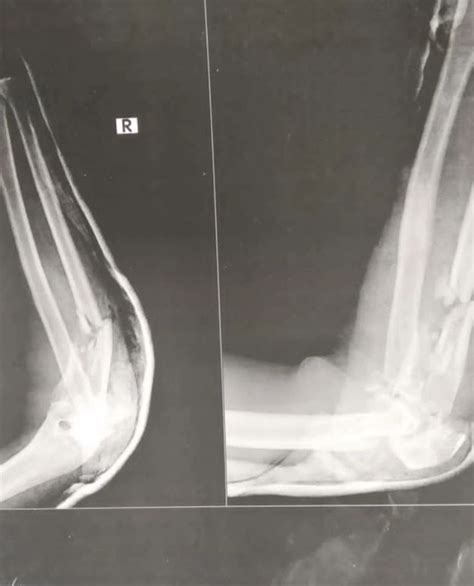 Comminuted Proximal Ulna Open Fracture With Associated Radial Head 27