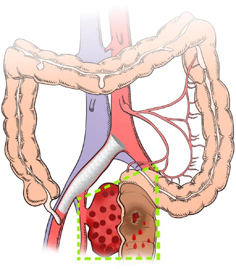 Figure From Hematochezia Due To Rectal Invasion By An Internal Iliac Artery Aneurysm A Case