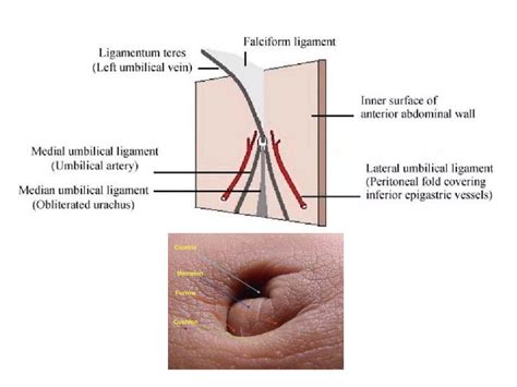 Umbilical Paraumbilical Incisional Hernia Revision Pptx