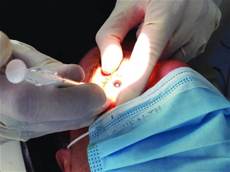 Speculum Free Intravitreal Injection Download Scientific Diagram