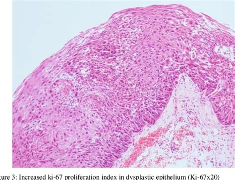 Figure 1 From Topical Mitomycin C Treatment In Corneal And Conjunctival Intraepithelial