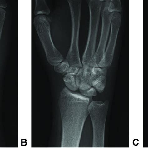 Imaging After Closed Reduction Showing The Widening Of The Scaphoid And Download Scientific