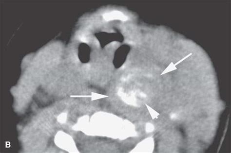 Benign And Malignant Neuroectodermal And Other Neurogenic Tumors