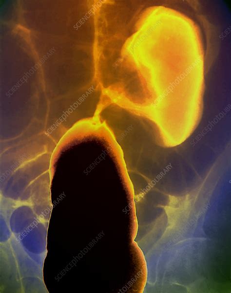 Twisted Sigmoid Colon X Ray Stock Image M290 0168 Science Photo