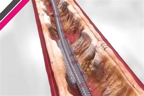 Orbital Atherectomy In Tirunelveli Advanced Heart Care