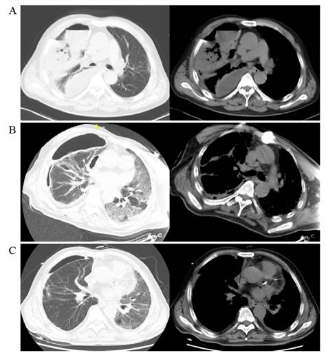 Pyopneumothorax Caused By Parvimonas Micra And Prevotella Oralis A Case Report