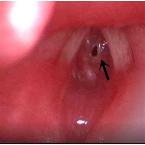 Subglottic Stenosis Arrow Indicates Subglottic Stenosis Because Of