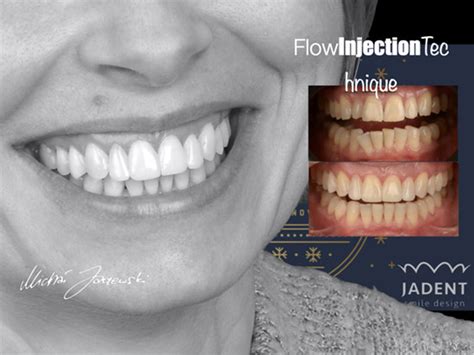 Flow Injection Technique Natrodent Kursy I Szkolenia Dla Techników Dentystycznych I Lekarzy