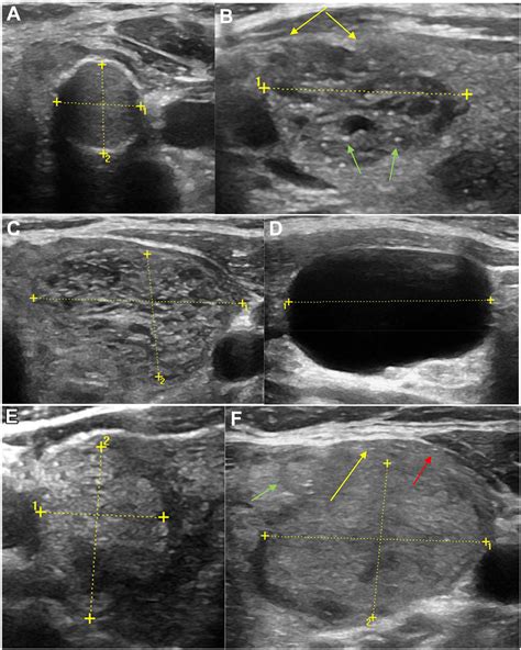 Thyroid Nodule Imaging A Novel Ultrasound Image Diagnostic Method For