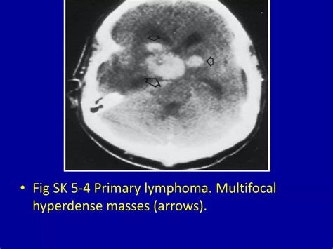5 High Attenuation Masses In A Cerebral Hemisphere On Pptx Death