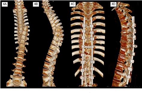 Figure 4 From Corrective Osteotomy Of Global Sagittal Imbalance In The