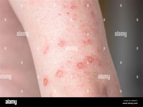 Dyshidrotic Eczema Arms