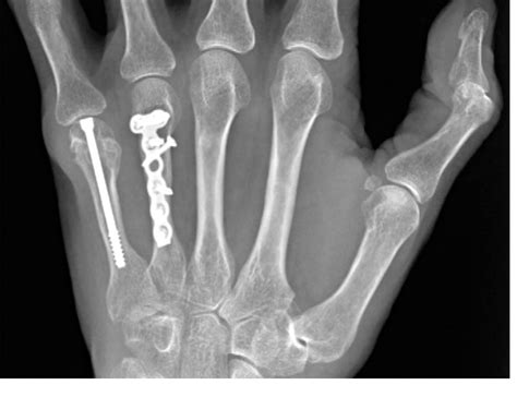 Figure 2 From Intramedullary Cannulated Headless Screw Fixation Of A Comminuted Subcapital