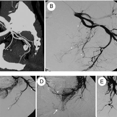 Pdf Radiological Anatomy Of Prostatic Arteries