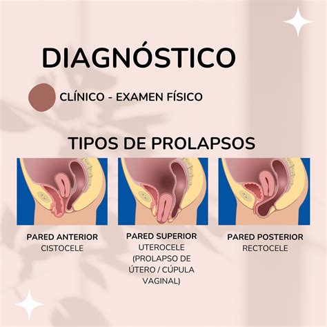 Utero Prolapsado Tratamento De Prolapso Genital Saiba Mais Medway