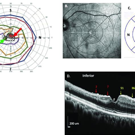Time Course Of Gcl Thickness Loss In Brao Patients A Aggregate Data