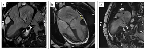 Panel A Cmr Balanced Steady State Free Precession B Ssfp Download Scientific Diagram