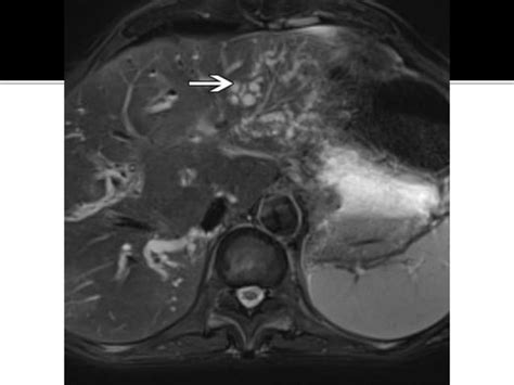 Extraintestinal Manifestations Of Ibd Inflammatory Bowel Disease A Complete Overview Pptx