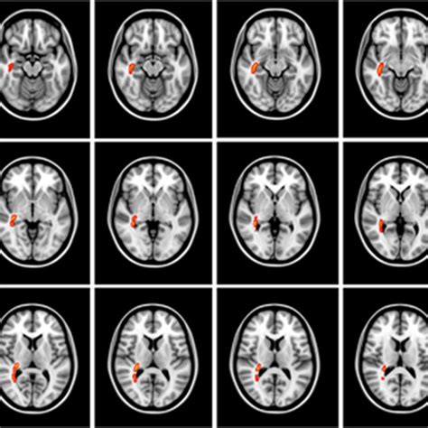 Regression Analysis Results Using Tract Based Spatial Statistics