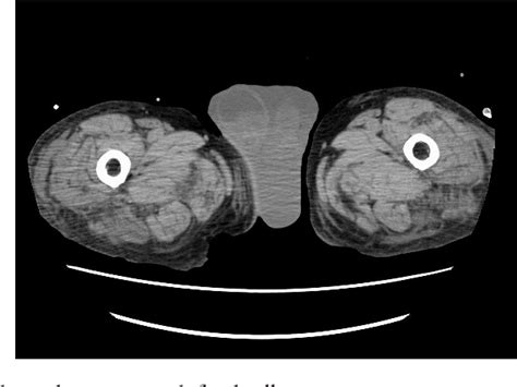 Figure 1 From Scrotal Abscess Semantic Scholar