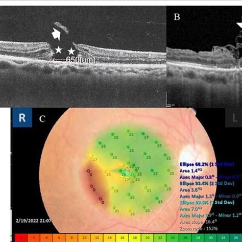 A Pre Operative OCT Radial Scan Of The Right Macula Of A 62 Year Old Download Scientific