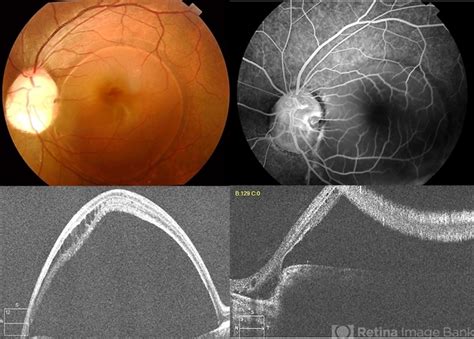 Optic Disc Pit With Coloboma Hybrid Anomaly Retina Image Bank