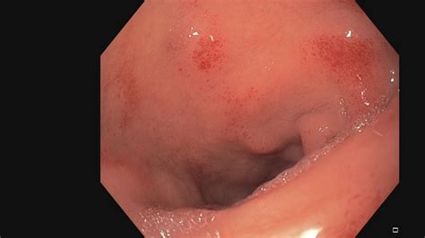 Intestinal Kaposi Sarcoma Endoscopy Campus