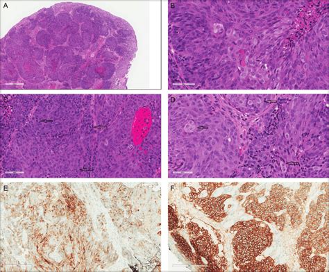 The Tumor Is Composed Of Lobules Nests Of Cells Separated By A Download Scientific Diagram