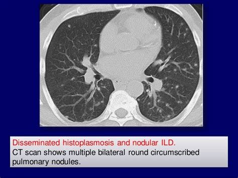 nodular pattern