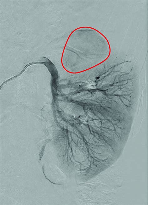 Renal Artery Pseudoaneurysm Applied Radiology