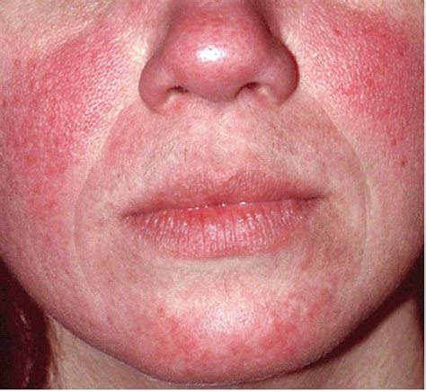 Learn About Demodex Dermatitis Vinmec