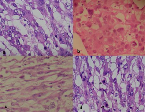 Features Of Malignant Myoepithelioma On Histological Examination