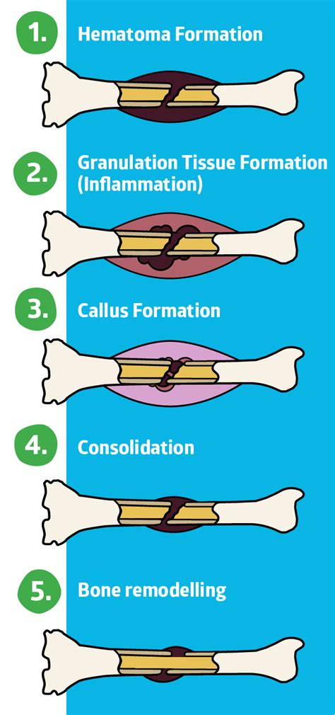 Bone Fracture Healing Supplements Do They Work Artofit