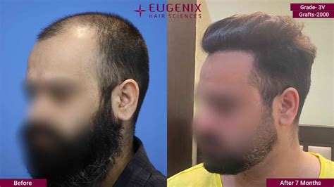 Norwood Scale 3v Baldness Hair Transplant And Treatment Uk